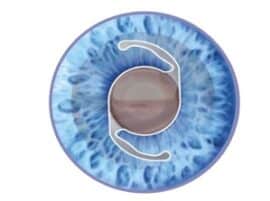 Refractive Lens Exchange Fort Lauderdale | Cataract Surgery FL